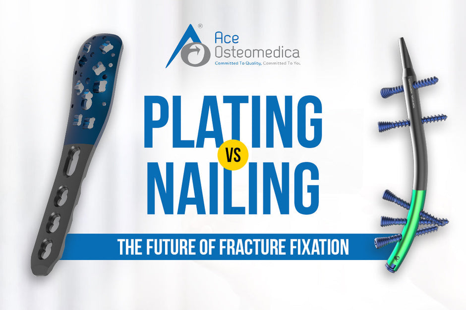 Plating vs Nailing: The Future of Fracture Fixation – Ace Osteomedica